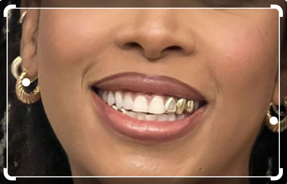 Gold Dental Implants: Are They As Good As Titanium?